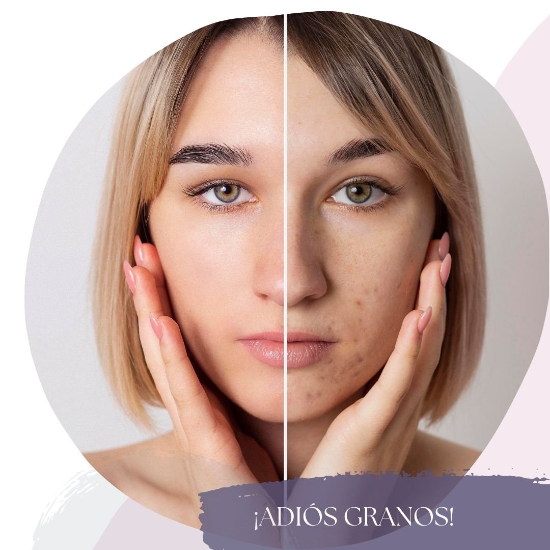 Solución para tu Acné Autoestima